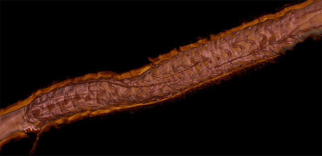 ‘Worrisome’ 3-Year Data From ABSORB II Raise Concerns About First ...