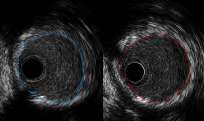New BRS Studies Show Promise for Second-Generation Devices With Thinner ...