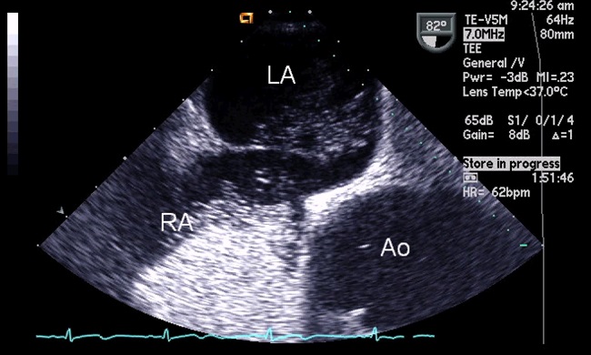 PFO and Migraine? New Study Zeros in on Atrial Septal Aneurysms | tctmd.com