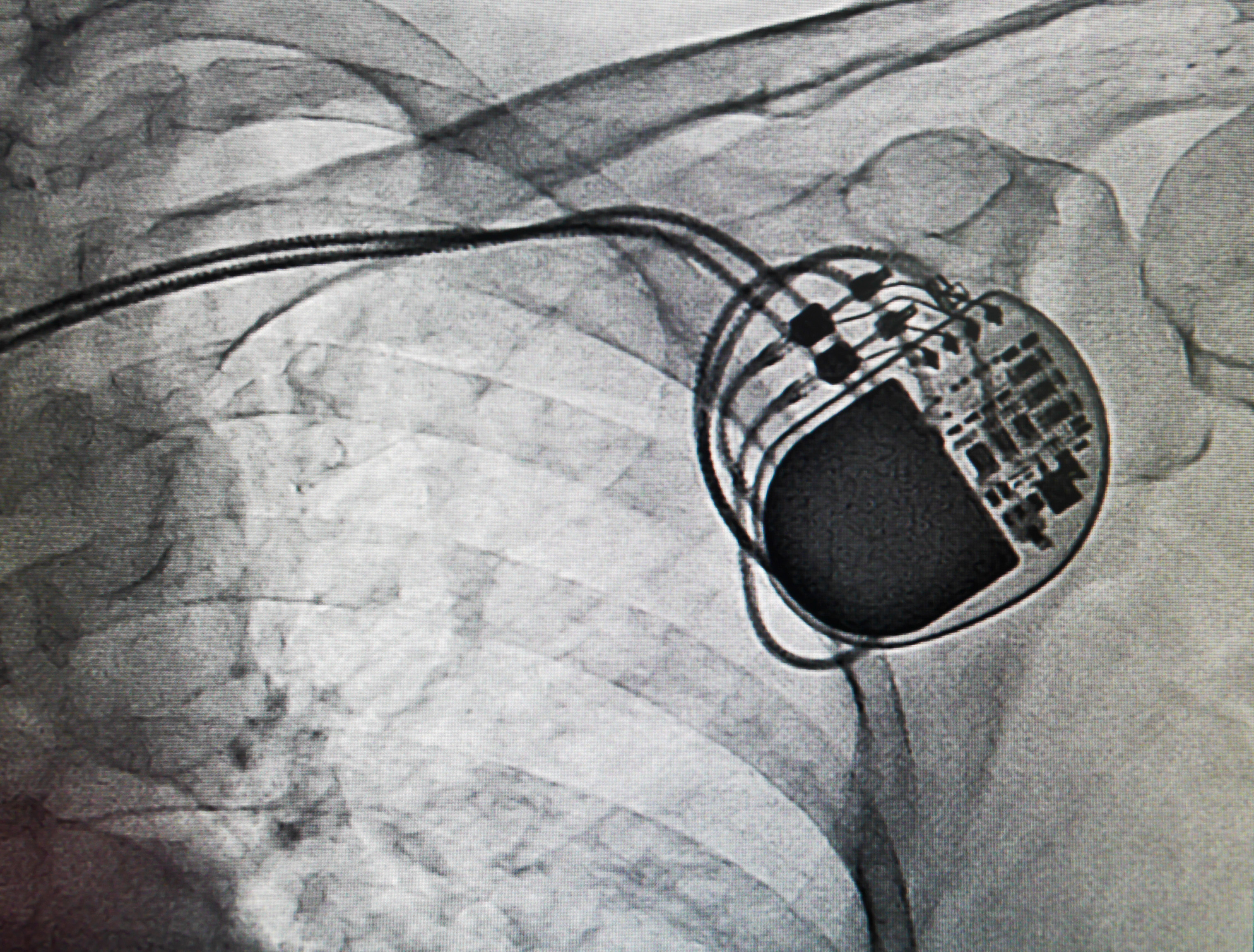 The Prickly Problem of Permanent Pacing After TAVR: One Hospital ...