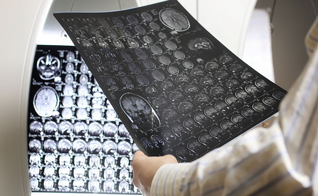 Post-TAVR, Nearly a Quarter of Patients Show New Signs of Silent ...