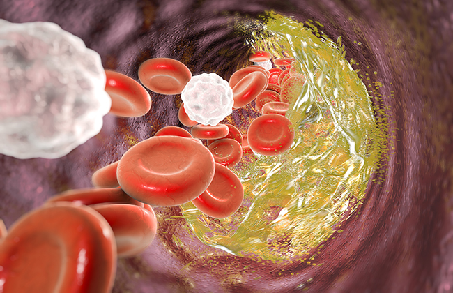 Plaque Attack: Options Evolve for Imaging Coronaries and Carotids, but ...