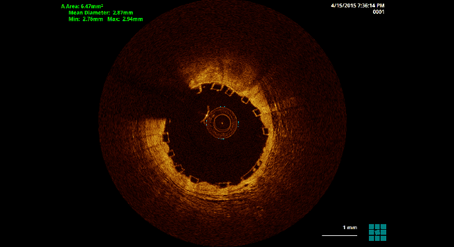 Absorb BVS Again Linked to Scaffold Thrombosis at 1 Year and Beyond ...