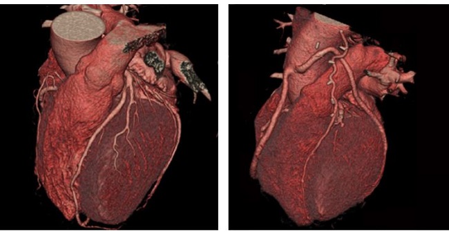 CTA Reduces MI Compared With Functional Stress Testing, but at a Cost ...