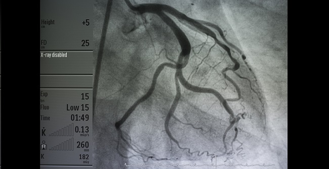 Angiography, Revascularization Safe in Acute MI Patients Taking OACs ...