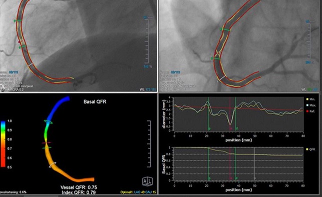 Quantitative Flow Ratio Shows Potential in Cath Lab | tctmd.com