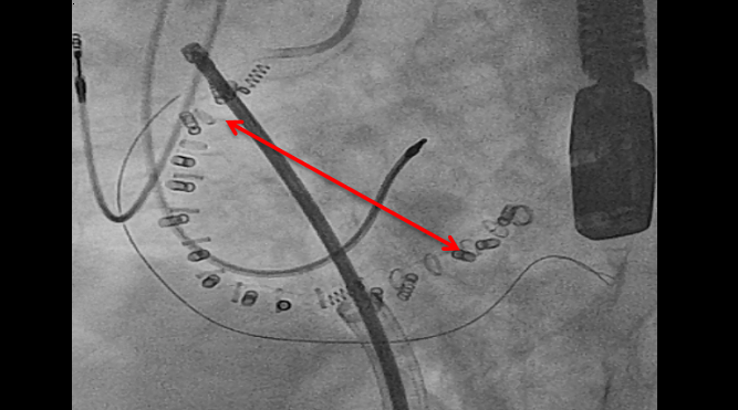 Edwards Voluntarily Recalls Cardioband ‘Anchors’ Used in Mitral and ...