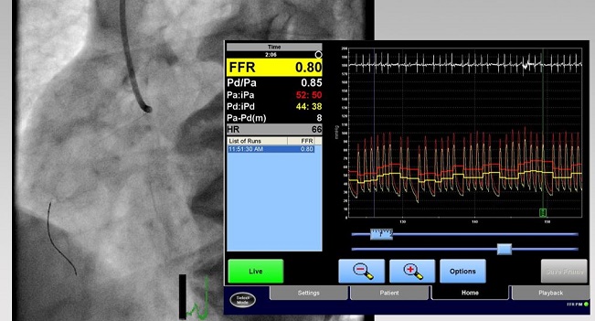 FFR in PCI for Stable CAD: Lasting Benefit Shown by FAME 2, SCAAR Data ...