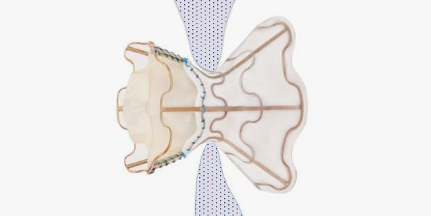 Novel Interatrial Shunt Shows Promise at 1 Year in HF Patients With ...