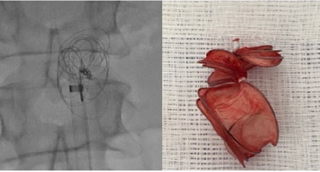 Device Embolization: Tools and Training Essential to Avoid Worst-Case ...