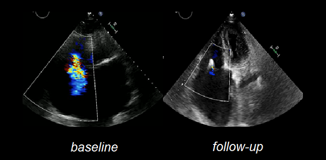Tricuspid Valve Interventions in High-Risk Patients: Midterm Outcomes ...