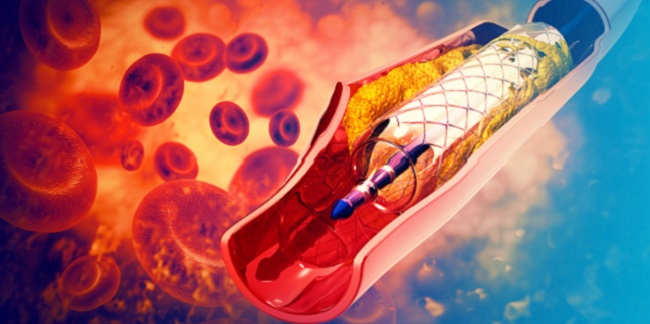 Three Years On, Absorb BVS Still Doesn’t Improve Myocardial Blood Flow ...