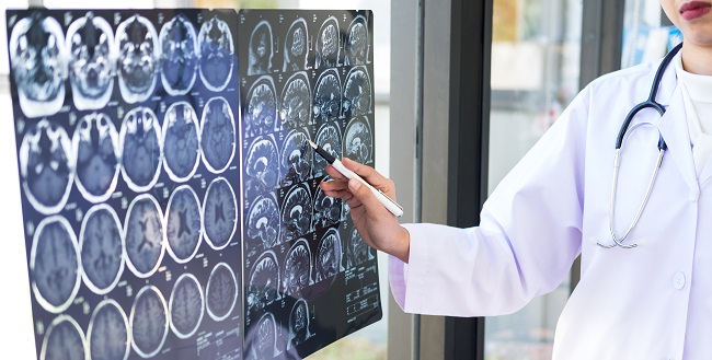 Stroke After PCI: Rare but Rising as Patient Complexity Climbs | tctmd.com