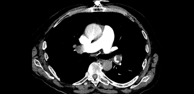 Interventional Options and Future Directions for Acute PE: New AHA ...