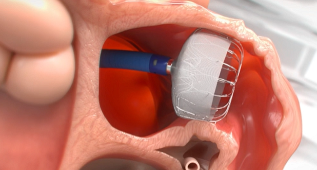 FDA Approves Next-Generation Watchman FLX Device for LAA Occlusion ...