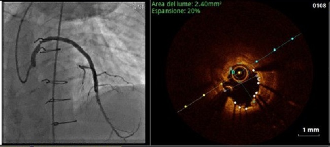‘Aggressive’ OCT Strategy for Stent Sizing Noninferior to IVUS: iSIGHT ...