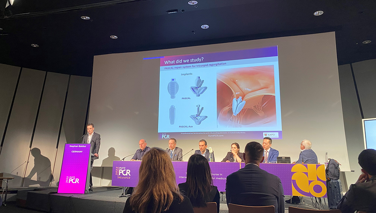 TriCLASP: Tricuspid Repair With Pascal Safe, Effective at 30 days ...