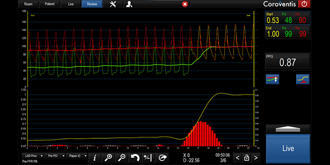 FFR Pullback Measure Linked to Likelihood of Angina Relief After PCI ...