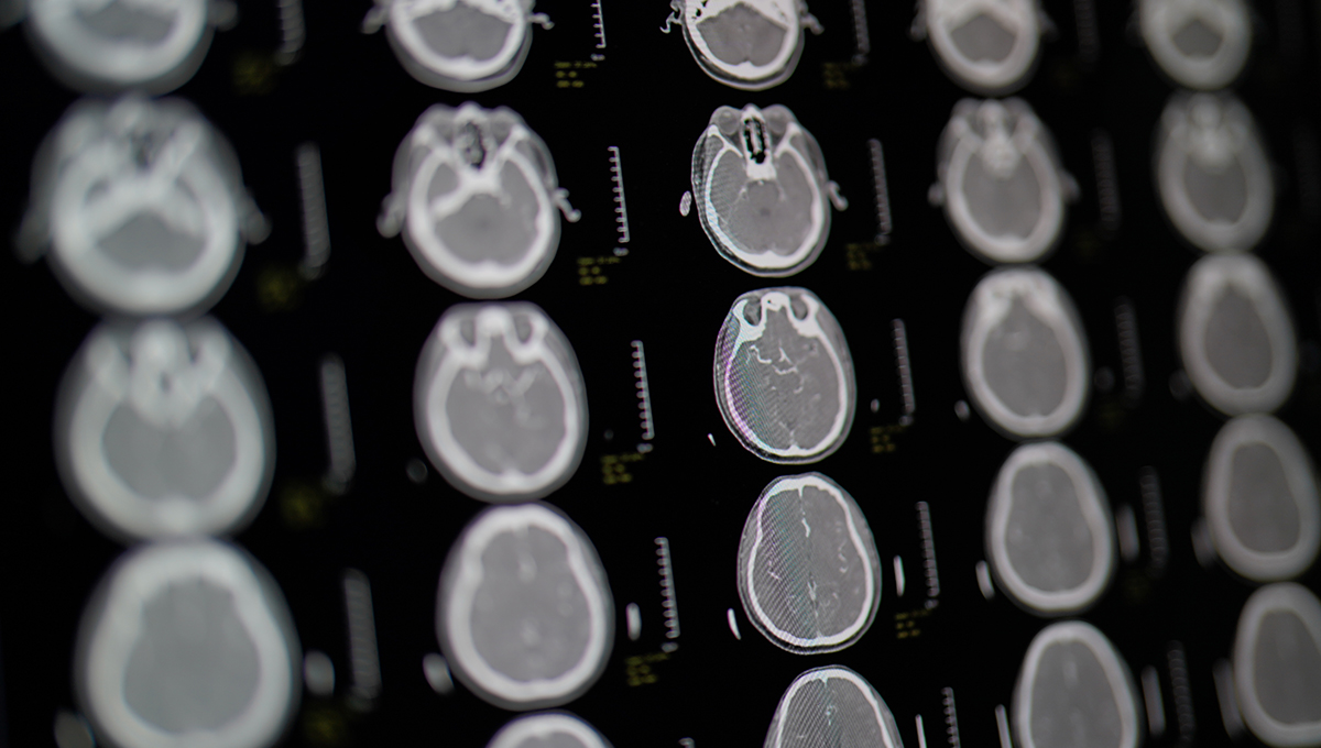 MR CLEAN-LATE Affirms 24-Hour Window Safe for Endovascular Stroke ...