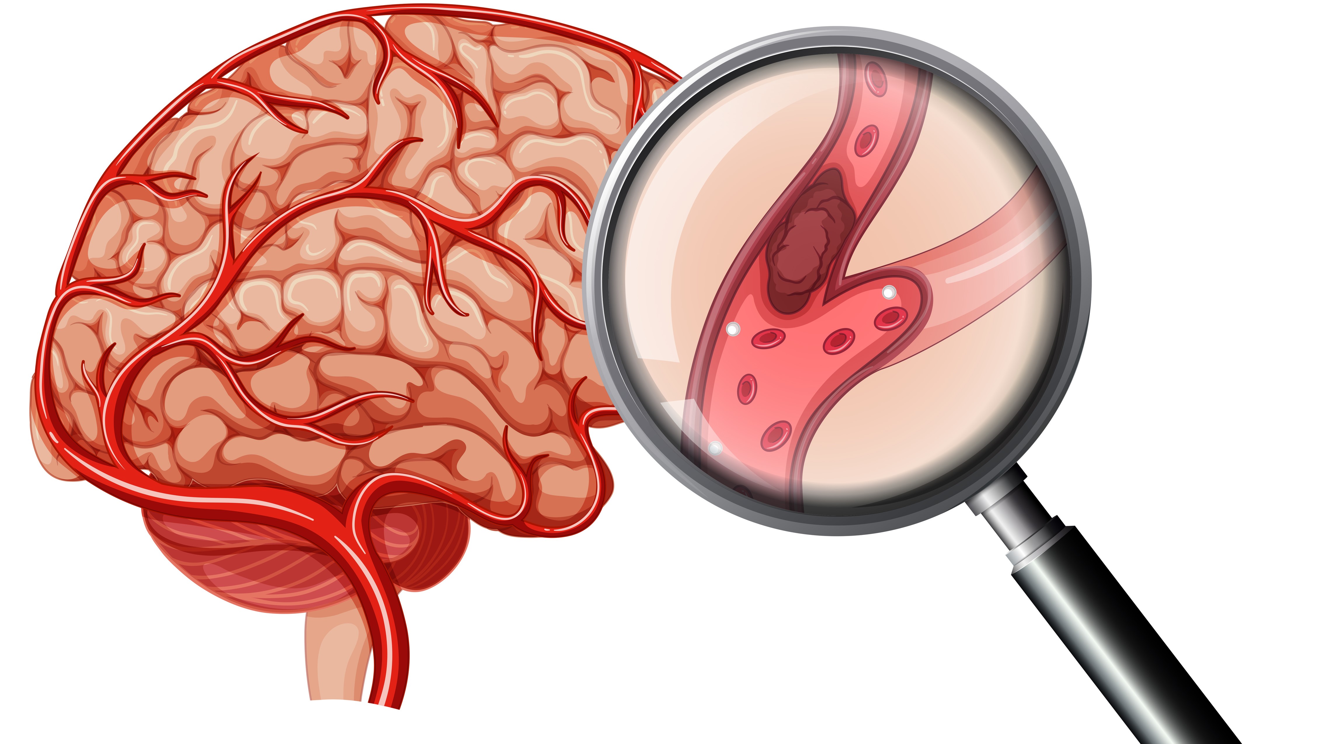 TESLA Falls Short, but Experts Still See Role for EVT in Large-Core ...