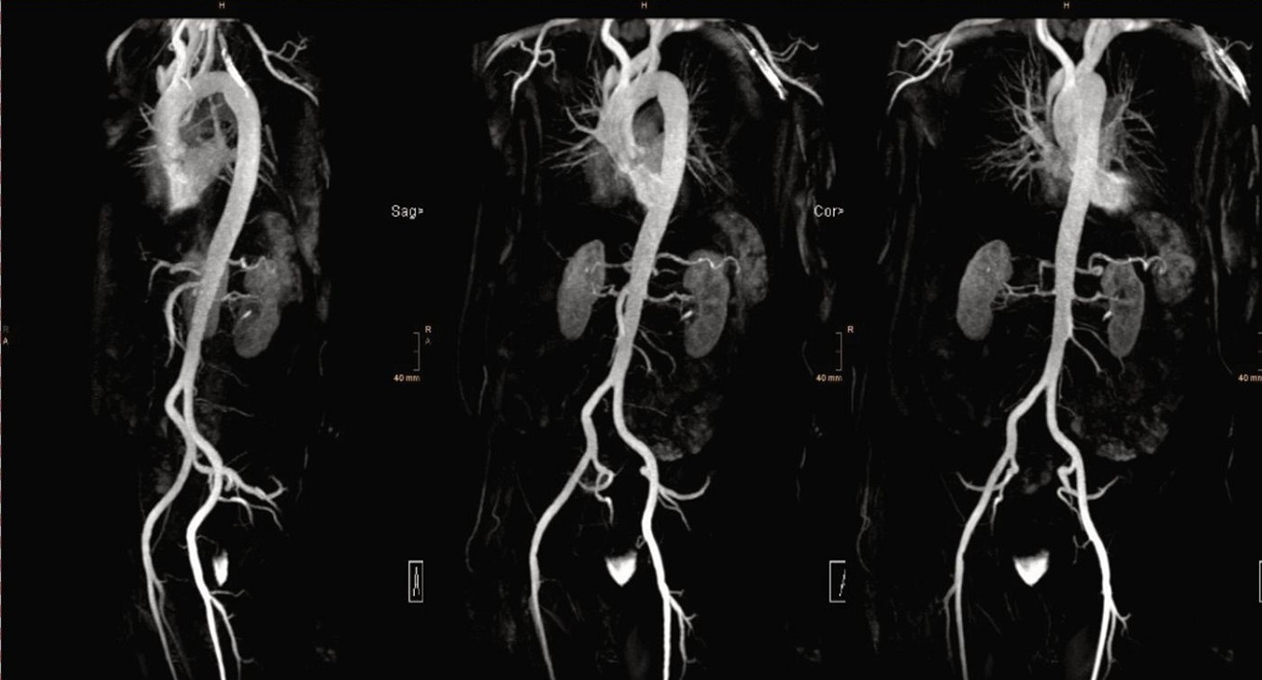 Cardiac MR Noninferior to CT for TAVI Planning, Small RCT Shows | tctmd.com
