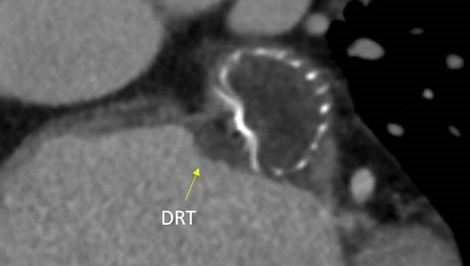 Outcomes Suffer When Device-Related Thrombus Persists or Recurs After ...
