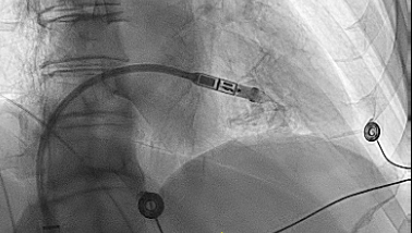 Micra Leadless Pacemaker Performs Well Through 5 Years | tctmd.com