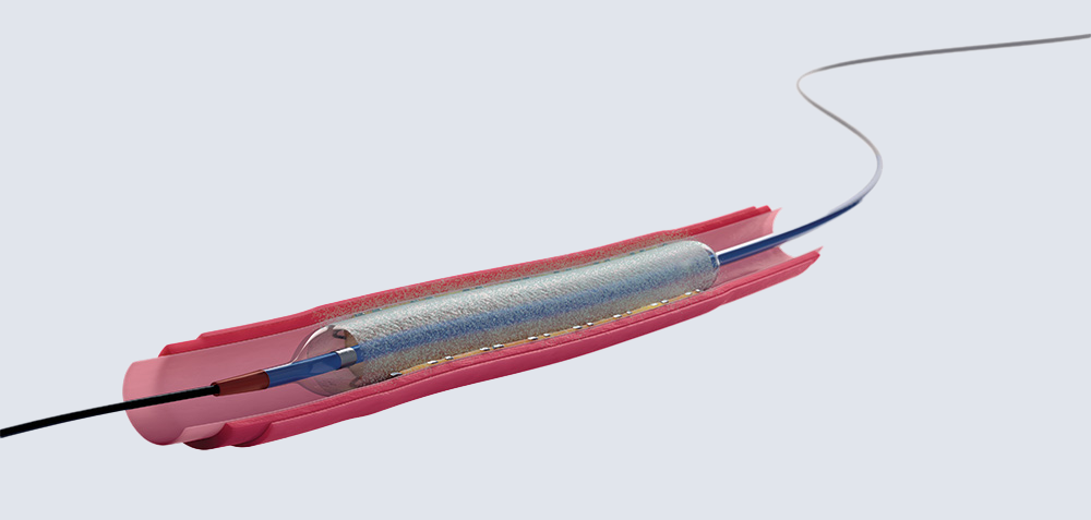 As US Rollout Begins for Coronary DCBs, Interventionalists Mull ...