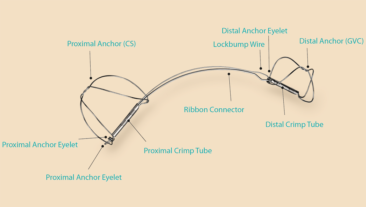 Positive Results With Carillon Mitral Device Seen in Real-world ...