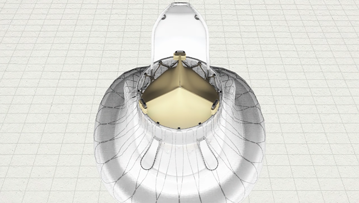 LuX-Valve TTVR Device Provides Favorable 1-Year Results | tctmd.com