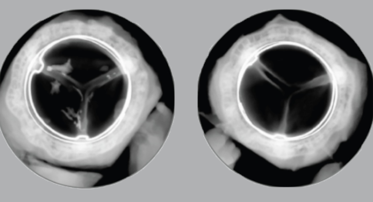 Solid Durability Seen With Surgical Resilia Tissue Aortic Valve | tctmd.com