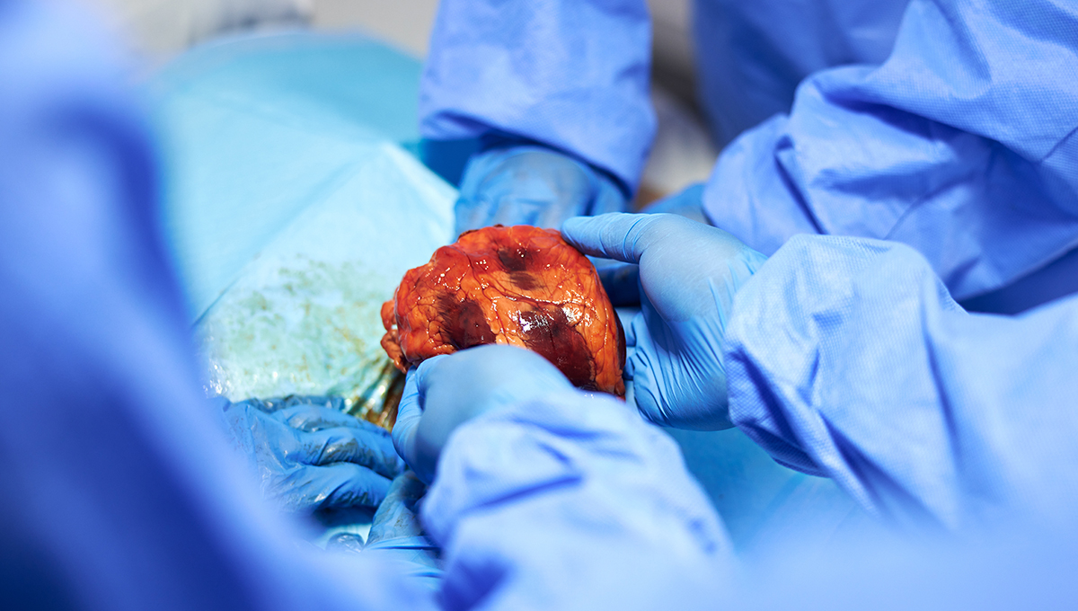 Donor Hearts Fare Better With Novel Method After Circulatory Death ...