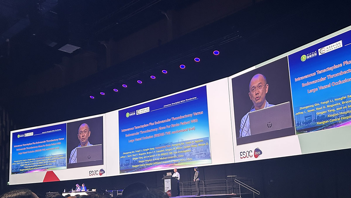 IV Tenecteplase Helps Before Stroke Thrombectomy: BRIDGE-TNK | tctmd.com