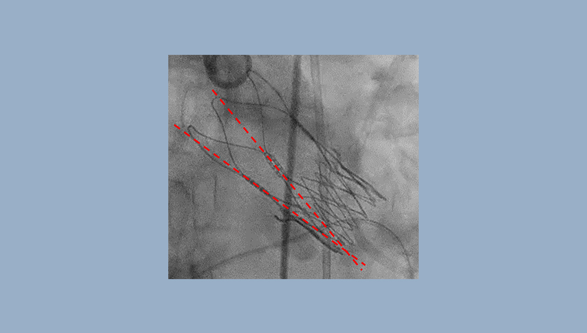 Underexpanded Acurate Valves Come With Higher Stroke Risk, Study ...